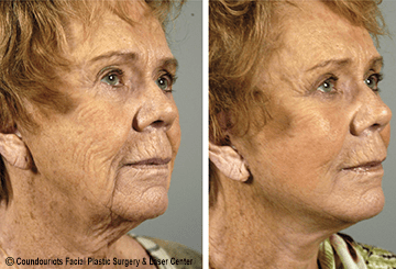 Mini Facelift - St.Petersburg, FL - Coundouriotis Facial & Plastic Surgery