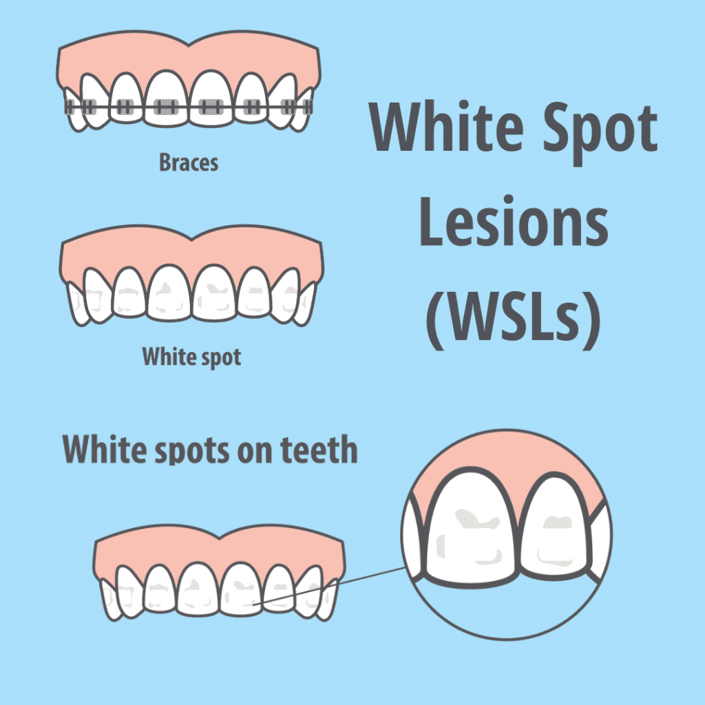 Treating White Spot Lesions
