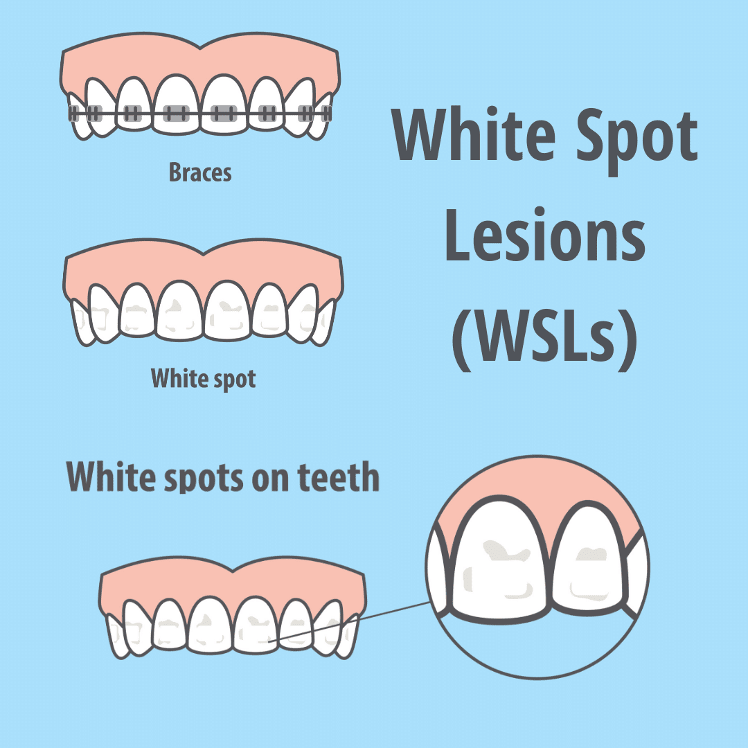 Treating White Spot Lesions