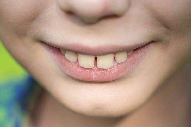 What You Need to Know About Protruding Teeth