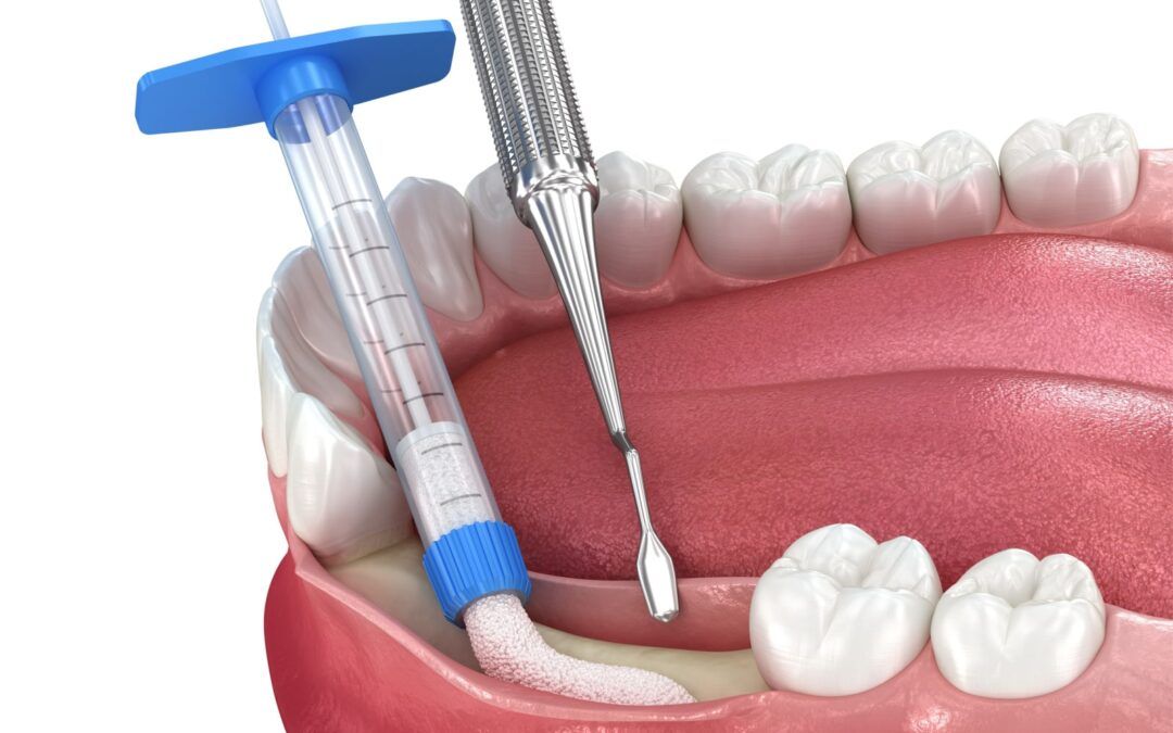 Learn About Dental Implants and Bone Grafting - Massih Orthodontics