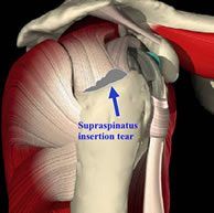 Rotator Cuff Repair - Bone and Joint SpecialistsLas Vegas Orthopedic ...