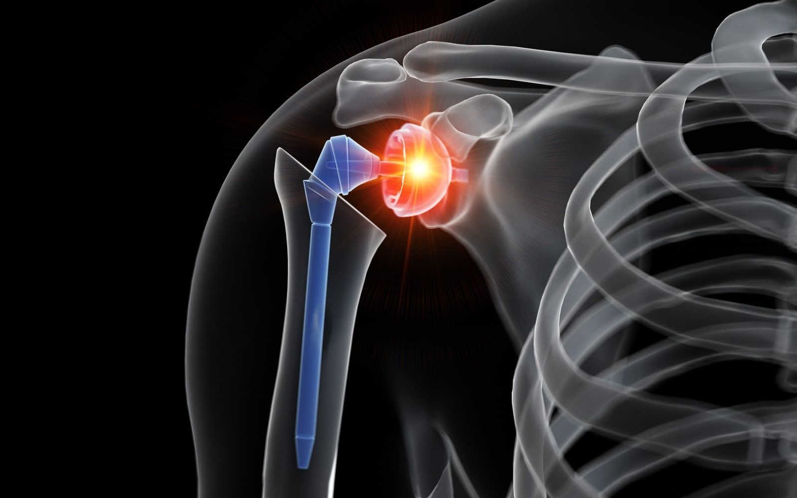 Improved Shoulder Replacements With Computer Assistance - Space Coast ...