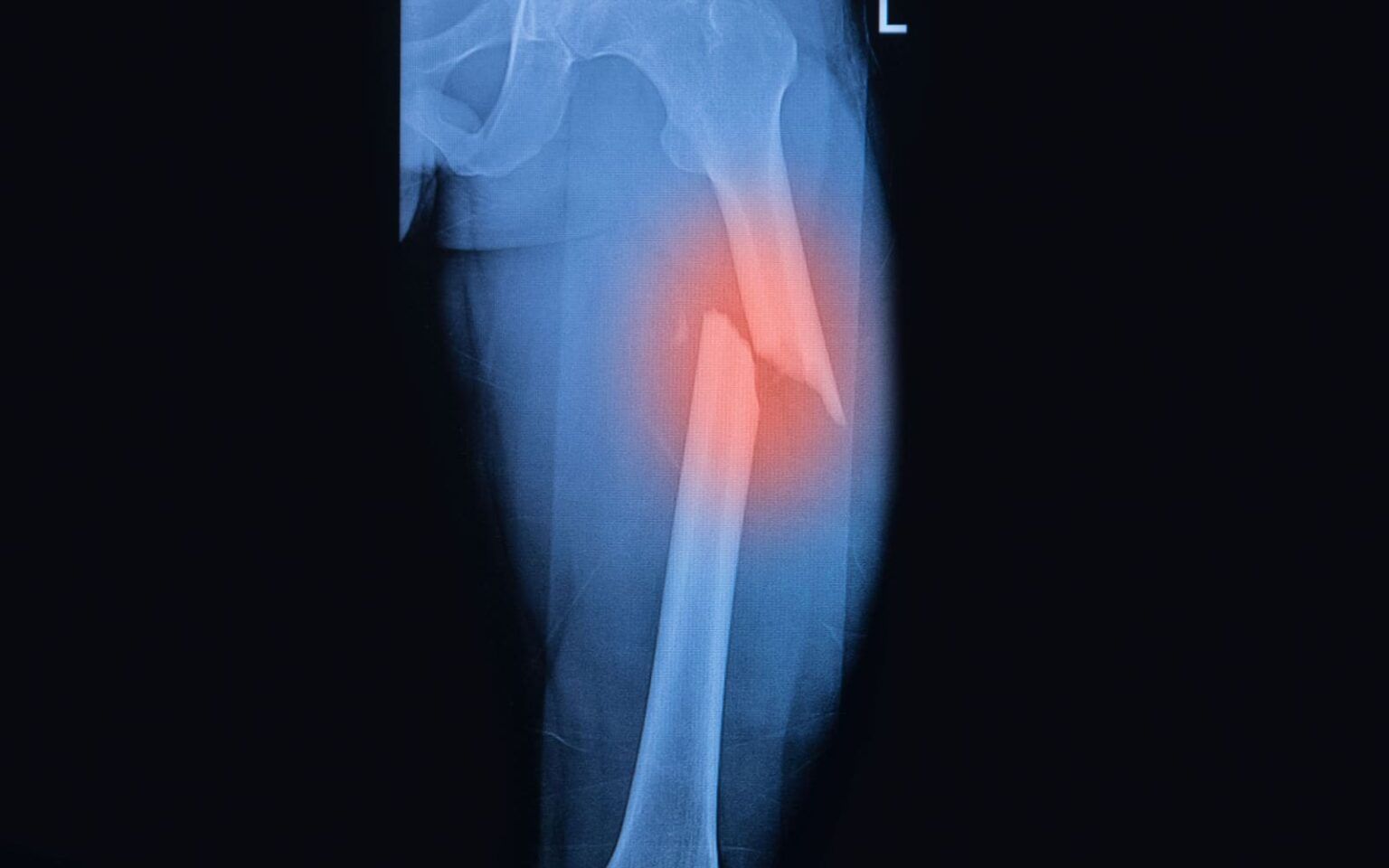 Femoral Fractures: Treating One Of Childhoods Most Common Bone Injuries ...