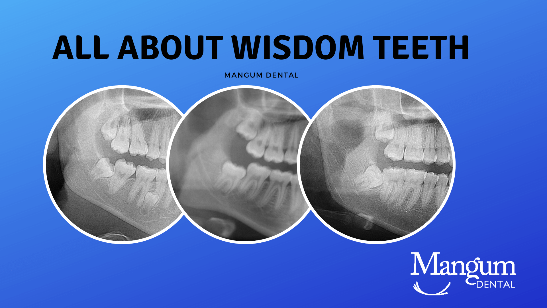 Oral Surgery & Wisdom Teeth - Mangum DentalPrescott, AZ | Mangum Dental