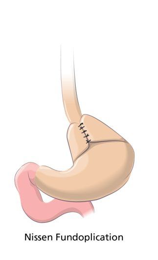 Da Vinci® Acid Reflux Surgery Nissen Fundoplication Palmer General