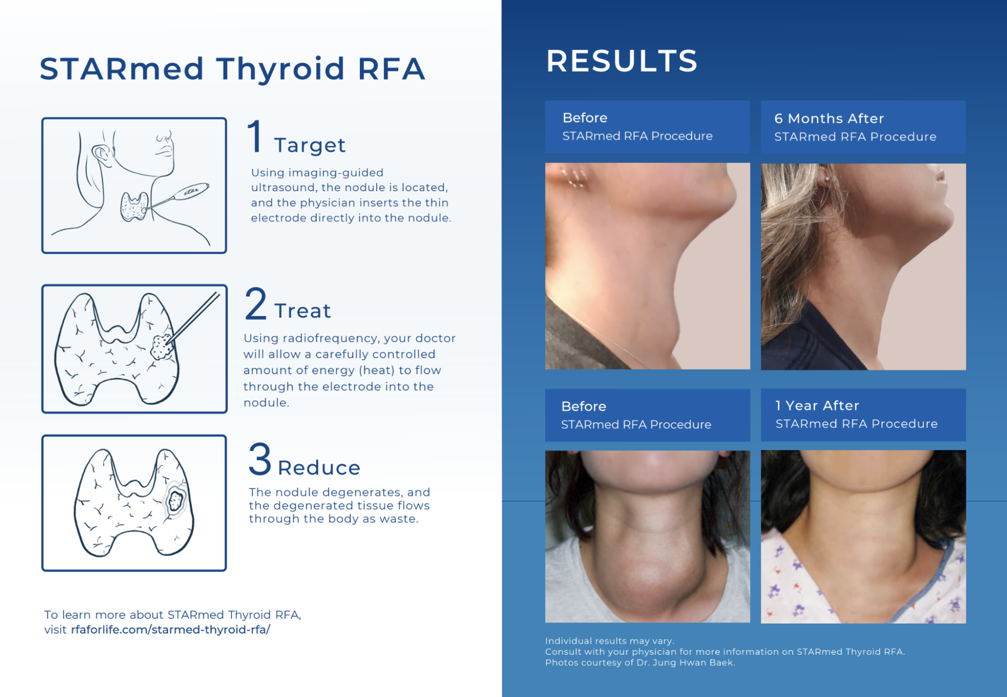 Thyroid Radiofrequency Ablation (RFA) » Palmer General Surgeon | Mat-Su ... Thyroid Radiofrequency Ablation (RFA) » Palmer General Surgeon | Mat-Su ...