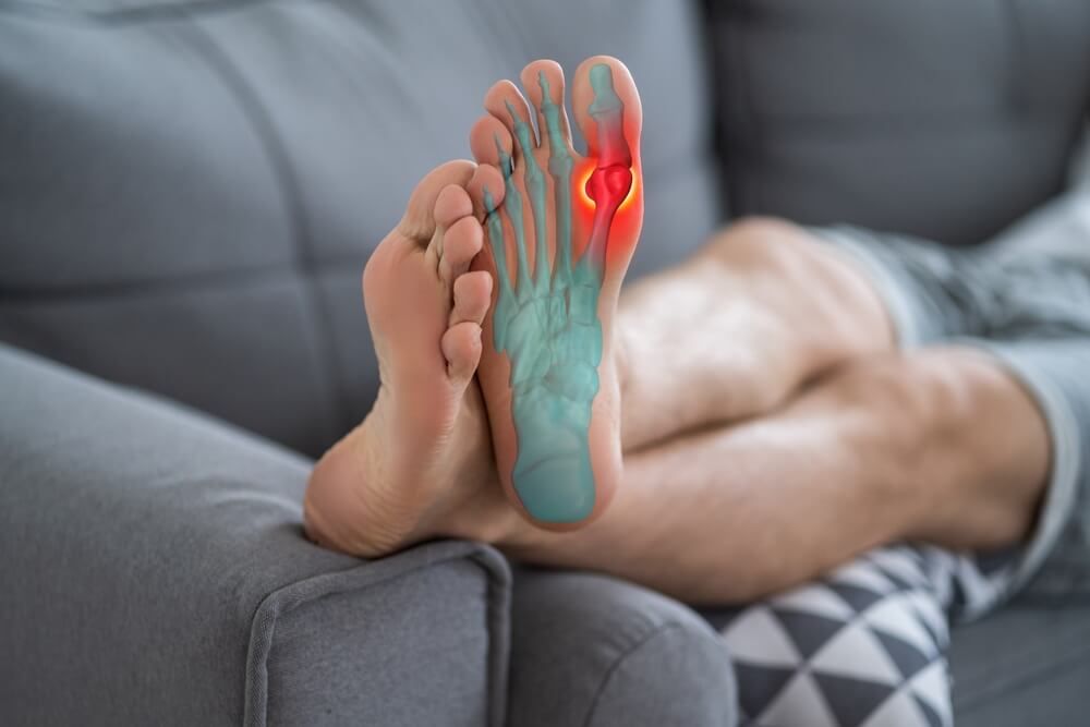 How to Recognize the Early Signs of a Gout Flare-Up - Arthritis Care of ...