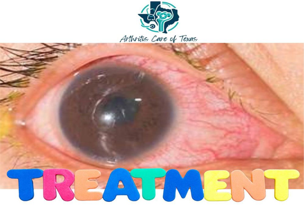 Navigating Treatment Options for Autoimmune Uveitis » Arthritis Care of ...