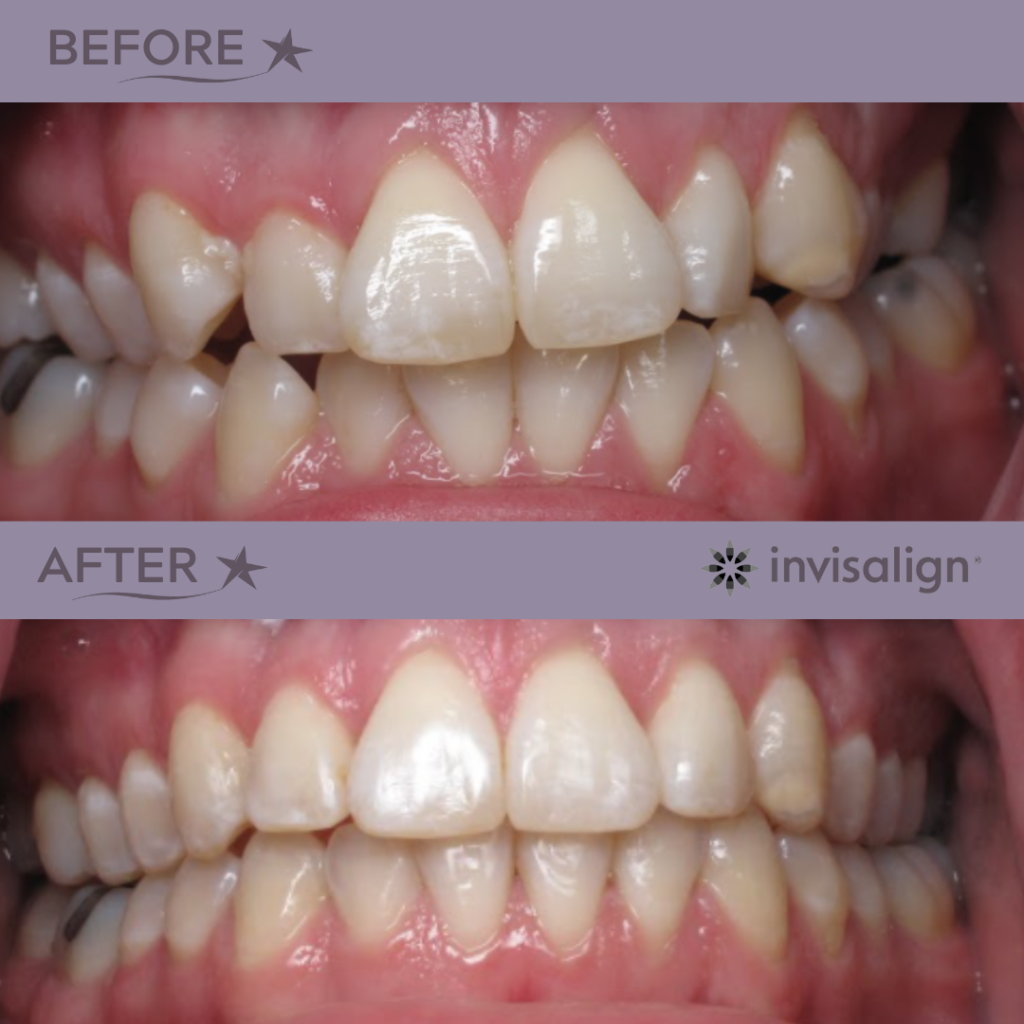 Invisalign » Westerville OH Dentist - Northstar Family Dental -Dr. Kulesa