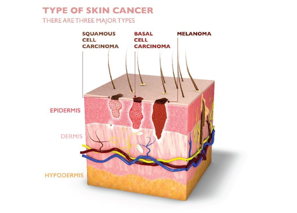 Skin Cancer » Roosevelt, UT - Uintah Basin Medical Center - Uintah ...