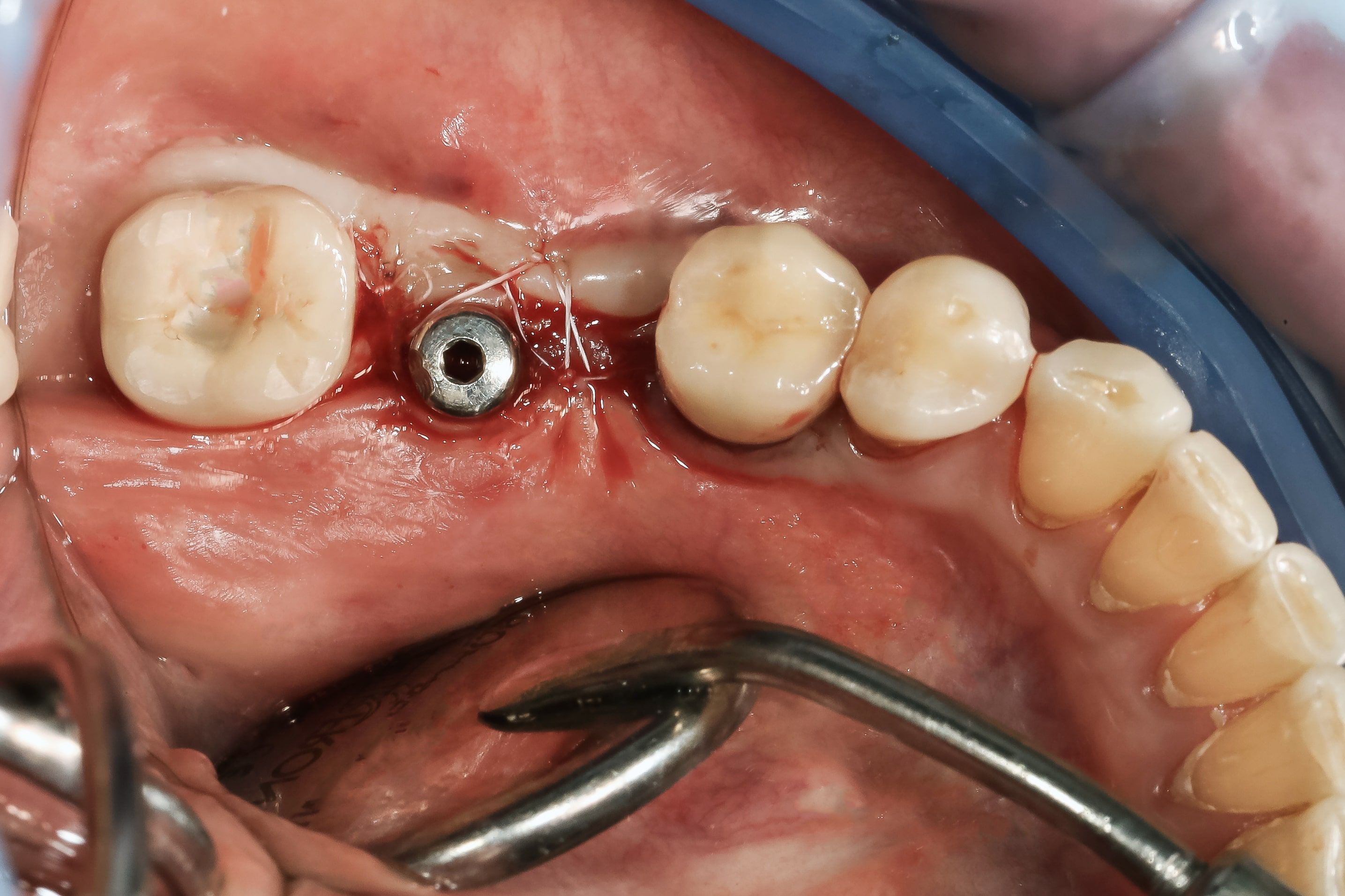 What Is Recovery From Implants Like Arc Dental What Is Recovery From Implants Like Arc Dental