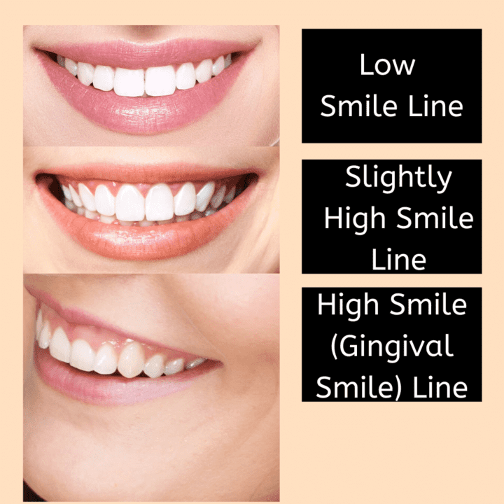 What is a Gingival Smile Line?